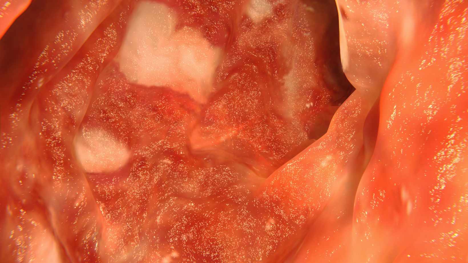 8 Natural Remedies for Ulcerative Proctitis - Dr Good Deed