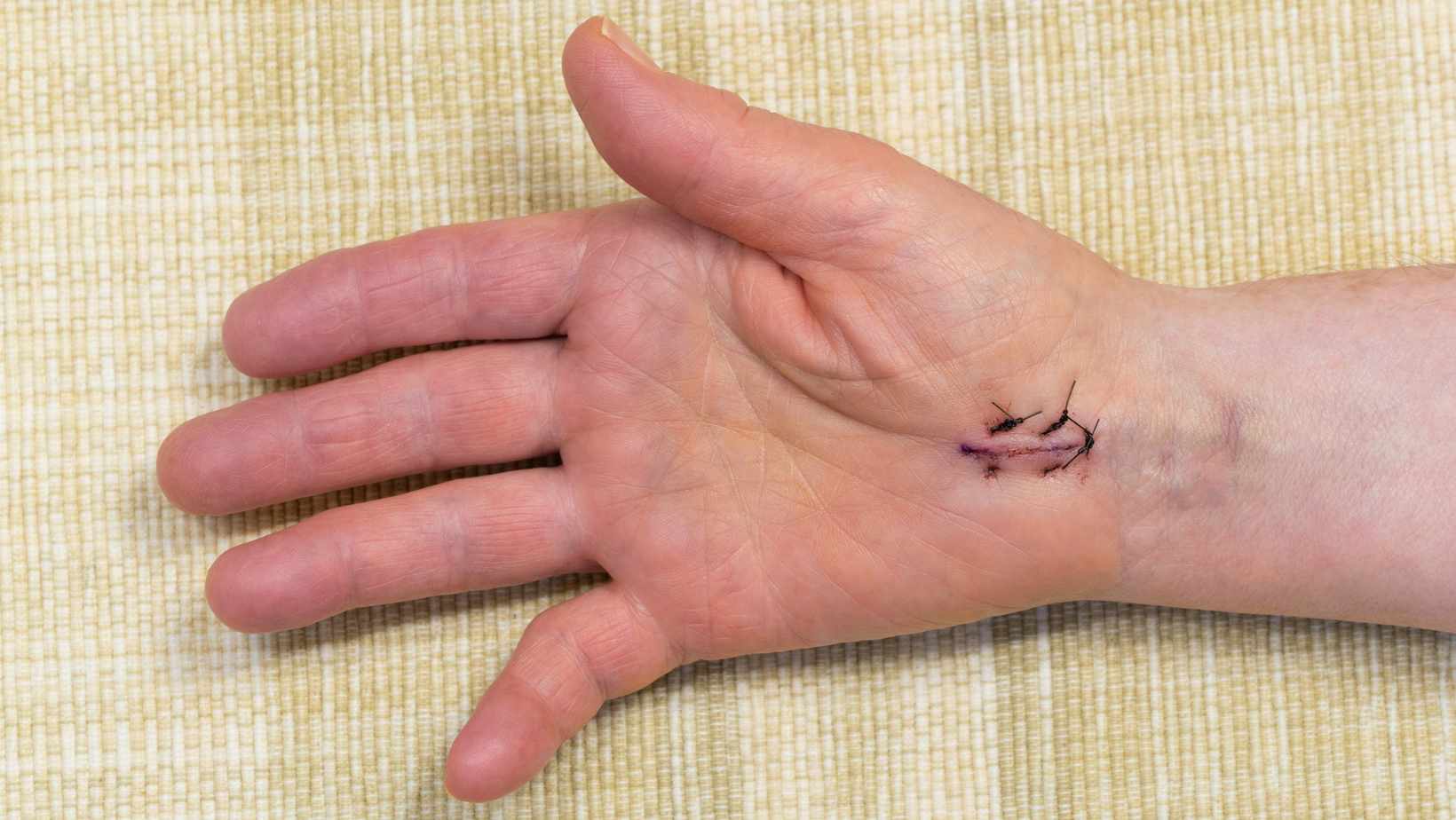 Pain in Surgical Stitches? Causes, Tips & When to Worry