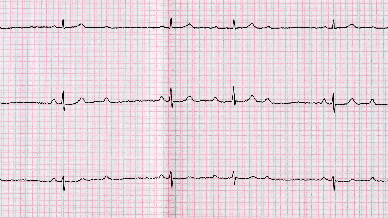Second Degree Heart Block: Symptoms, Causes And Treatment